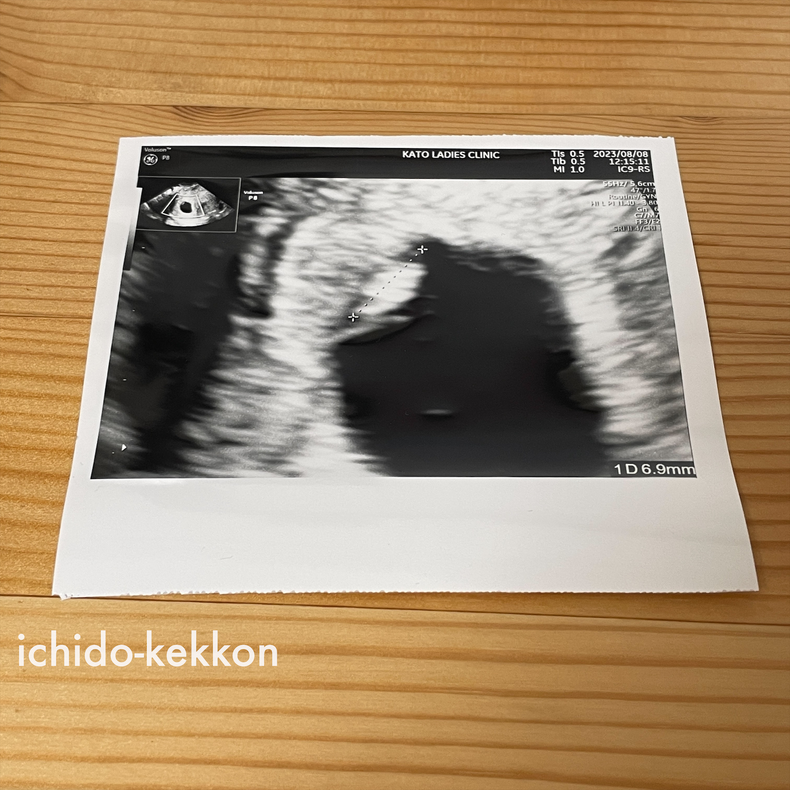 不妊治療 加藤レディスクリニック KLC 妊婦検診 6W6D 38歳 ｜ 一度は結婚してみない？